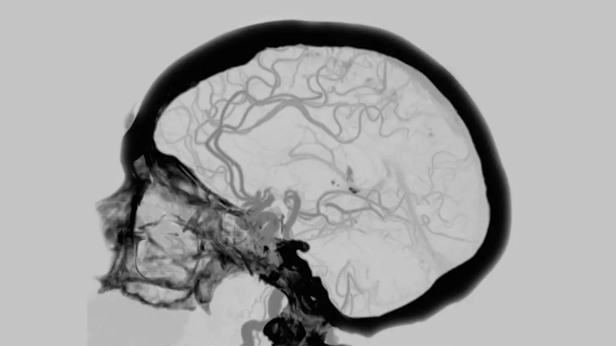 La schizophrénie a-t-elle évolué avec notre cerveau ?