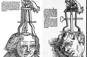 Reproductions of woodcuts trepanation tina buku widang 1500s telat ngeunaan bedah.