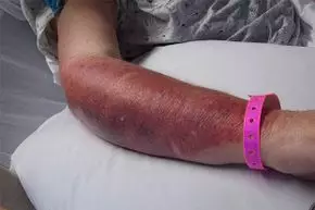 Este paciente tem celulite de uma infecção estreptocócica.