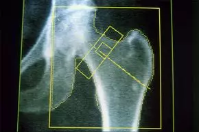 Това изображение показва лявото бедро на възрастна жена с остеопороза. Изследвания на руски космонавти, прекарали месеци в космоса, установиха, че те са загубили до 20 процента от костната си маса по време на престоя си.