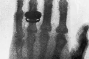 Една от първите рентгенови снимки, направени от немския физик Вилхелм Рентген, показваща ръката и брачната халка на съпругата му. Едва по-късно хората научиха колко опасно може да бъде продължителното излагане на рентгенови лъчи.