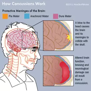 Concussions કેવી રીતે કામ કરે છે