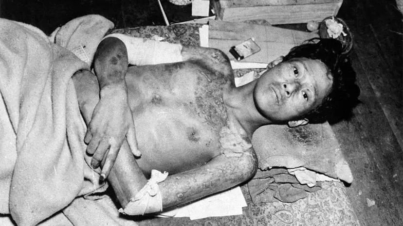victimă a bombardamentului de la Nagasaki