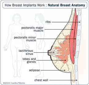Як працюють грудні імплантати 8157_1